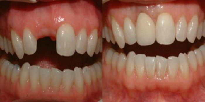 Regrowing Teeth Understanding Human Tooth Regeneration