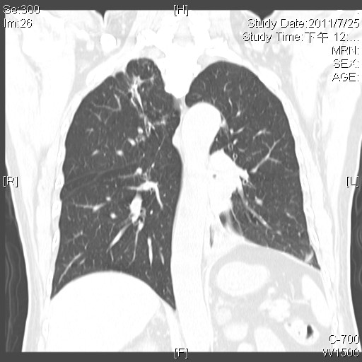 淨元法師之大醫院小醫師: old TB on CT image