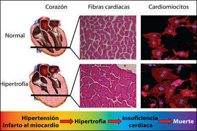GABRIELA CRIOLLO - ENFERMEDADES DEL CORAZÓN: Hipertrofia cardiaca ...