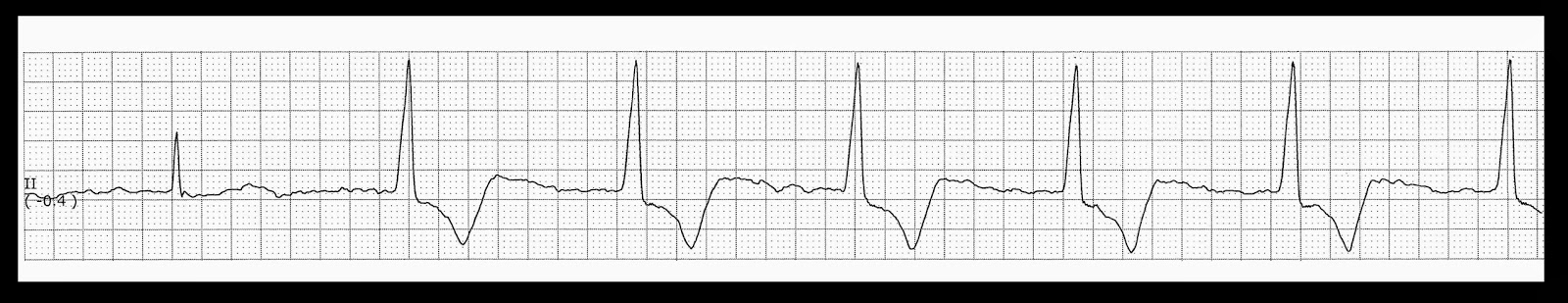 Float Nurse: Practice Rhythm Strips 292