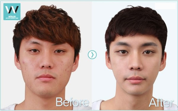 Male Two Jaw Surgery Before, After Pictures