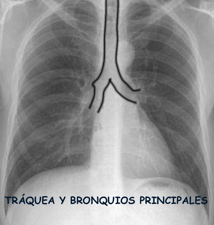 Radiografía de Tórax. Bordes del Mediastino. TC, TAC.