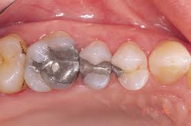 The Daily Floss: Just Flappin' My Gums: The Pros and Cons of Amalgam ...