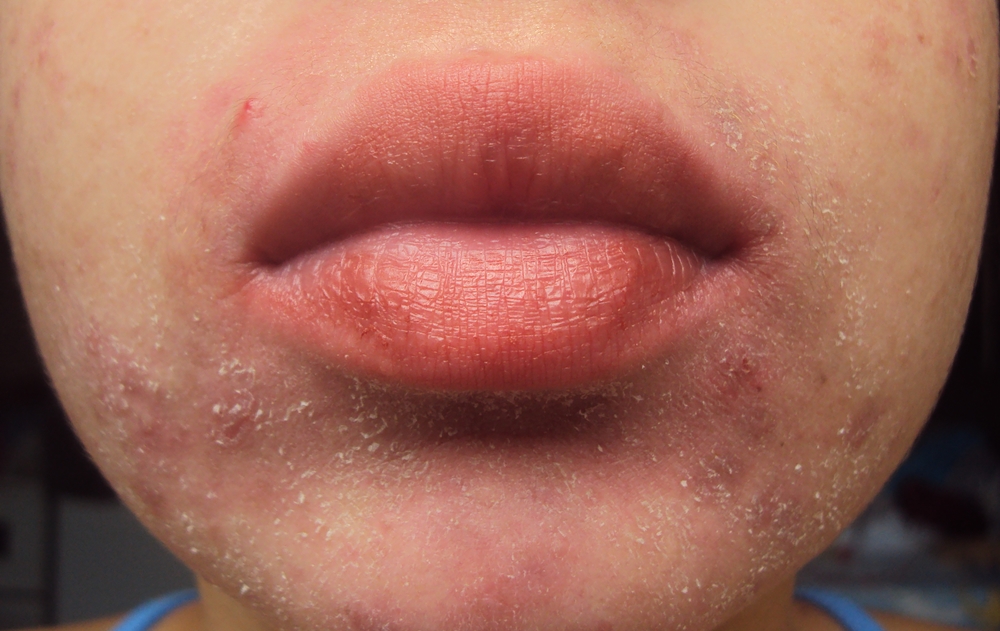 Boca Ressecada Nos Cantos - RETOEDU