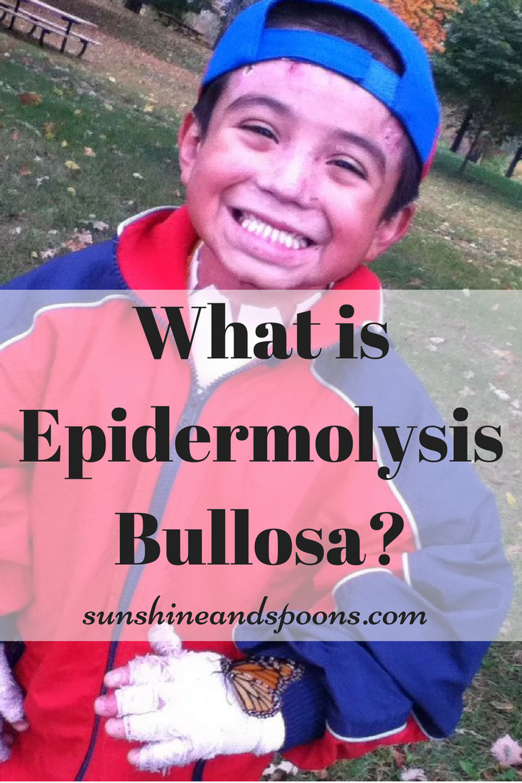 Sunshine and Spoons: Meet AJ - Epidermolysis Bullosa