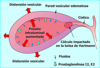 MEDICINA: COLECISTITIS AGUDA