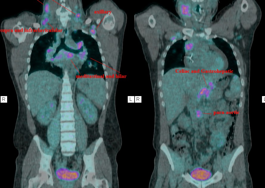 Kicking The Hodge PET Scan Results kicking-the-hodge-pet-scan-results