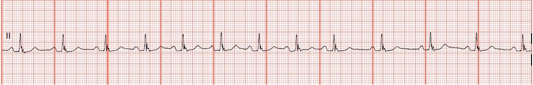 ECG Rhythm Strip Quiz 67