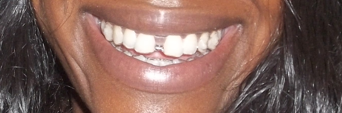Getting rid of my gap with Invisalign: Invisalign Progress: Pics!!!!!!!!!
