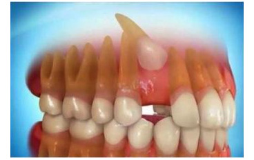 Entendiendo mi sonrisa : Dientes Retenidos