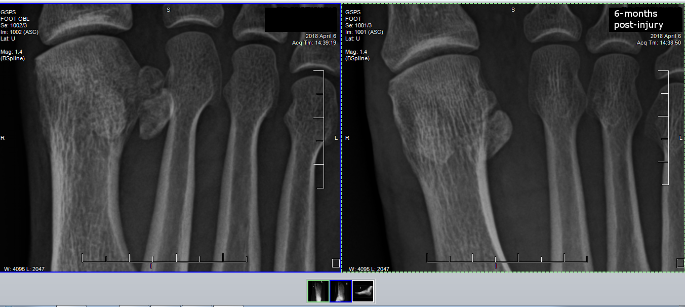 Foot and Ankle Problems By Dr. Richard Blake: Fractured Sesamoid with ...