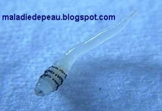 Maladie de Myase (myiases) - Maladies de Peau