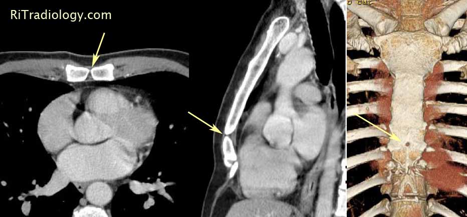 RiT radiology: Sternal Foramen