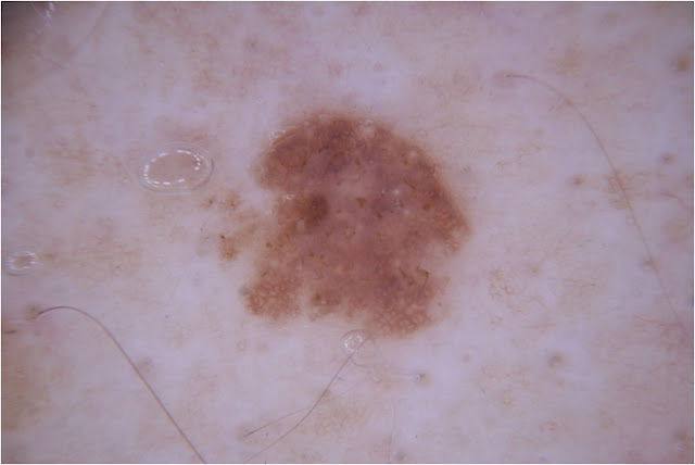 Dermatoscopia: Network like structures