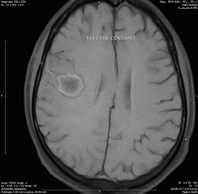 Ultimate Radiology : Frontal lobe abscess : follow up MRI