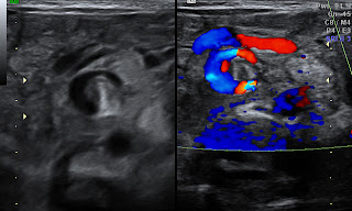 Double Bubble Sign - Sumer's Radiology Blog