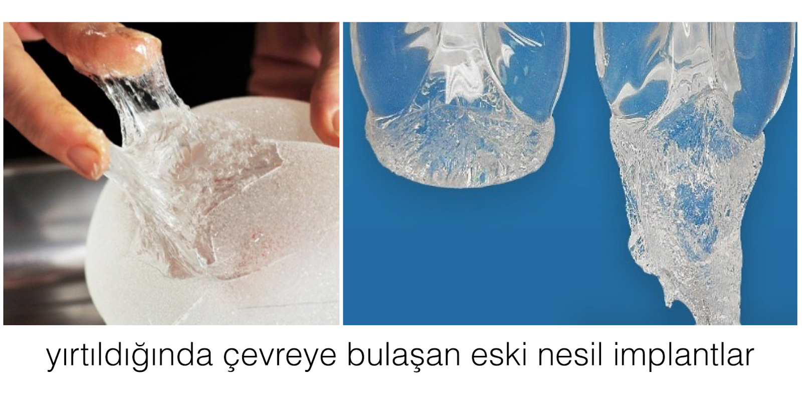 Prof. Dr. Halil İbrahim CANTER: High Cohesive Silicone, Form Stable ...