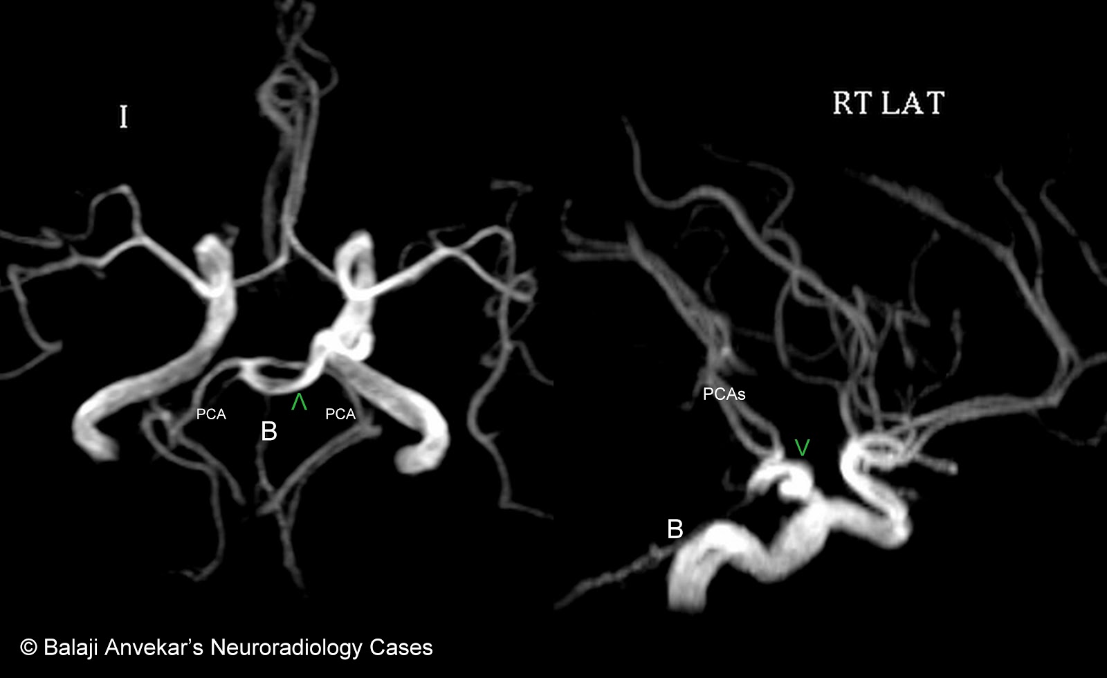 Dr Balaji Anvekar Frcr Persistent Trigeminal Artery Mr Angio