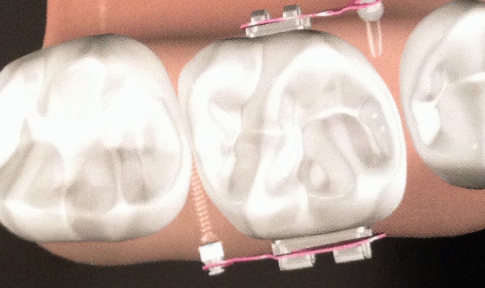 Blog do Mini-implante: Intrusão de molar usando o MINI-IMPLANTE ...