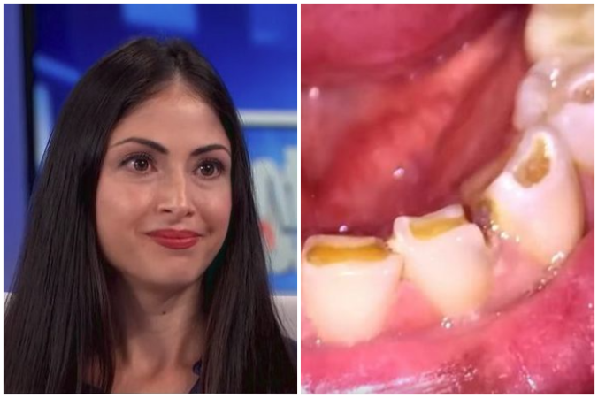 Twin’s teeth were melting away, but dentists had no idea why. 10-years ...