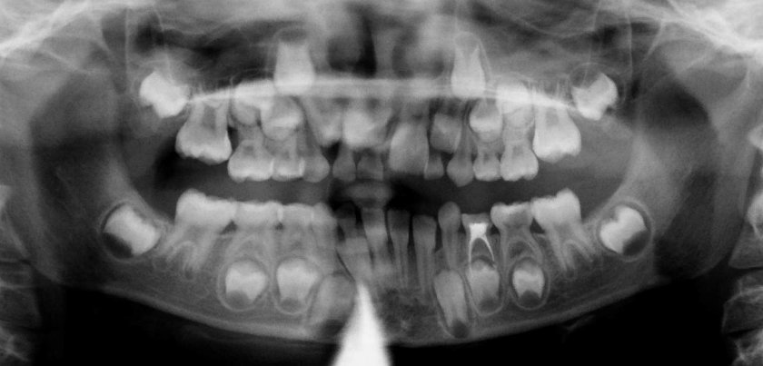 thunder bear and wren: Baby Teeth