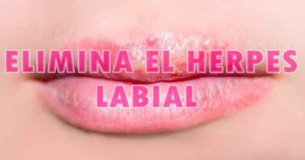Cura el herpes labial. - Por vos para vos