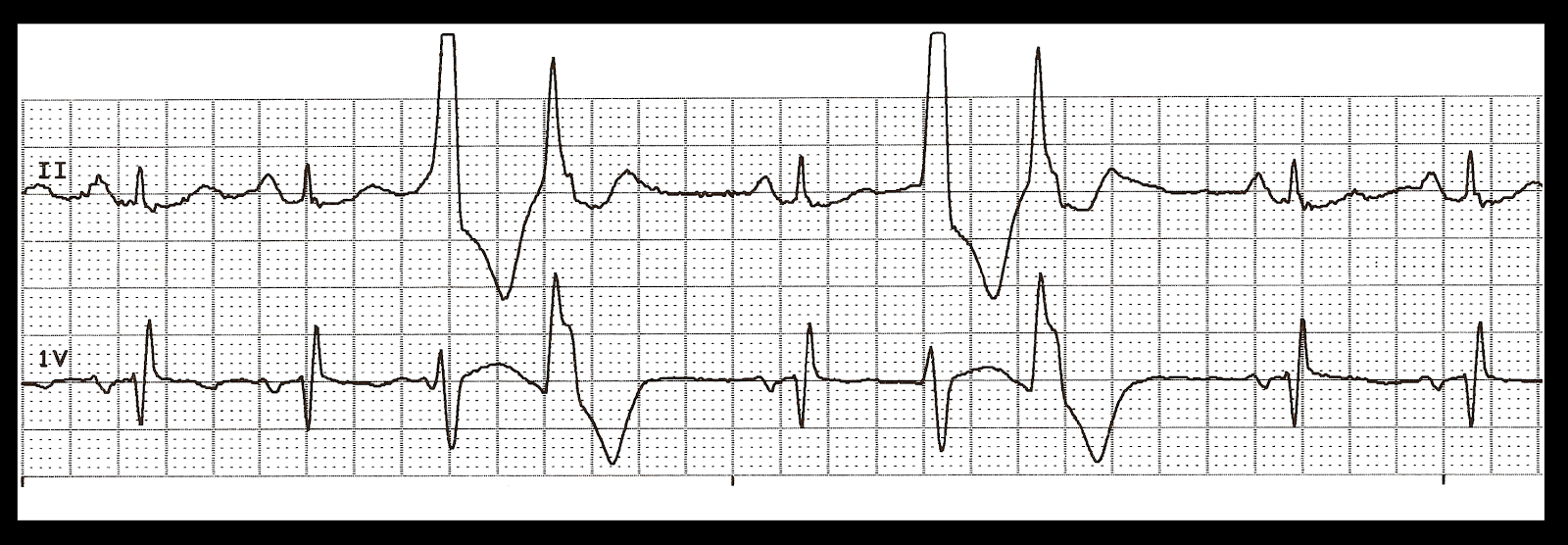 Practice EKG Strips 311