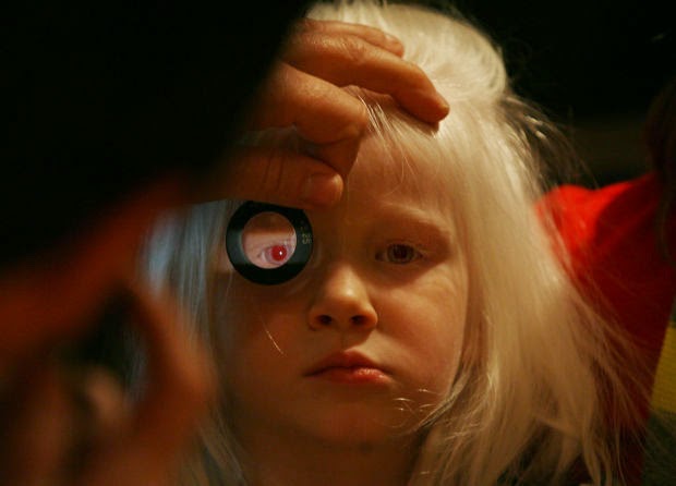 Window Of The World " l'oeil ": Albinism and the Vision Problems