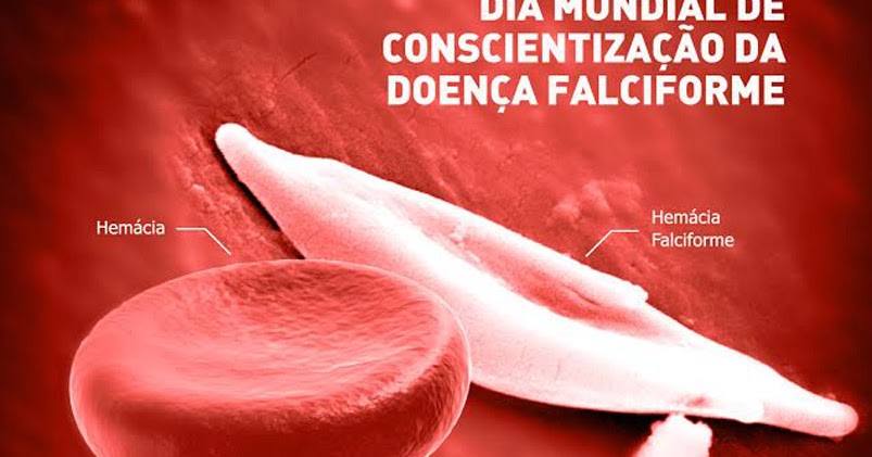Anemia falciforme | Bio Nota 10