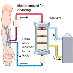 TODO SOBRE DIÁLISIS RENAL