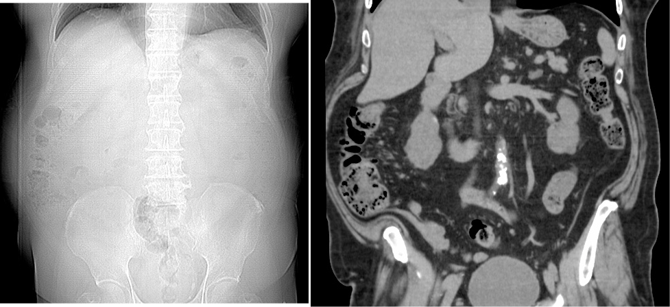 Hospitalist ~なんでも無い科医の勉強ノート~: 腹部のPseudohernia