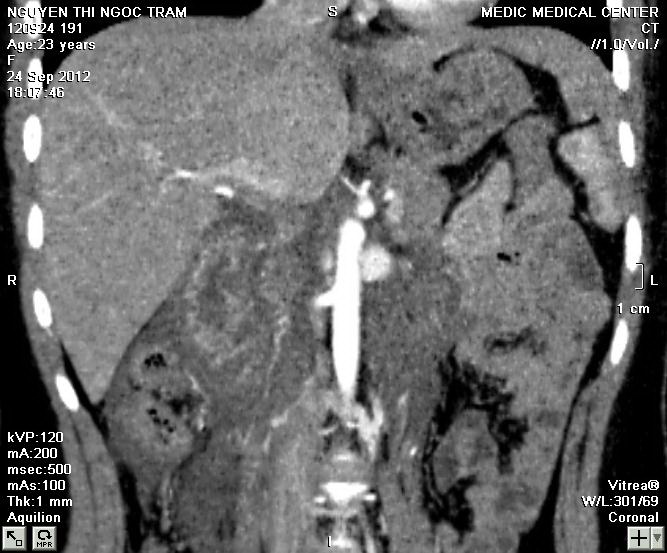 VIETNAMESE MEDIC ULTRASOUND: CASE 141: RUPTURE of DUODENUM, Dr PHAN ...