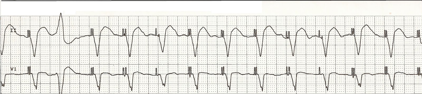 EKG Rhythm Strip Quiz 46