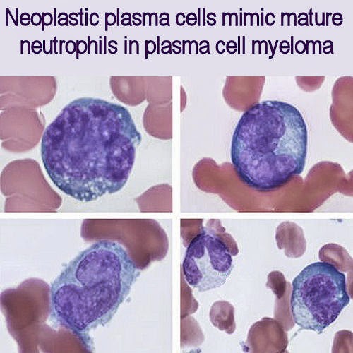 Medical Laboratory and Biomedical Science: Neoplastic plasma cells ...