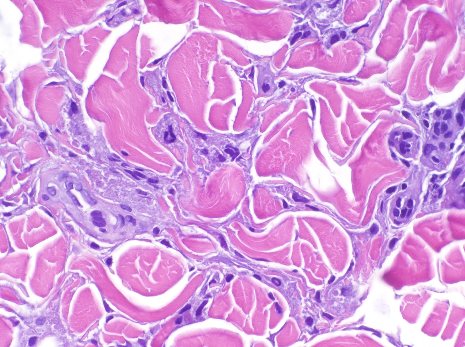 VIRTUAL GRAND ROUNDS IN DERMATOLOGY 2.0: Atypical Granular Cell Tumor