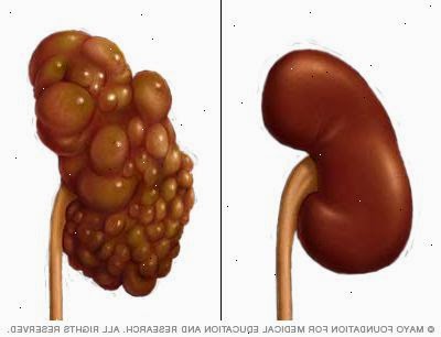 La polykystose rénale | Récap' IDE