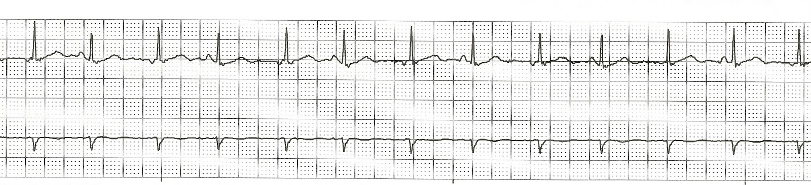 EKG Rhythm Strip Quiz 82