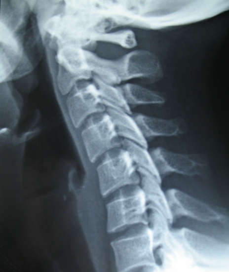 Tecnicos Radiologos: Latigazo Cervical. Hallazgos en Radiodiagnóstico