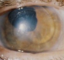 Photos for Aphakia and Pseudophakia ~ YOUNG DOCTORS' RESEARCH FORUM