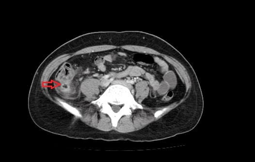 For Better Life..: 우측 복통과 옆구리 통증, 게실염 진단