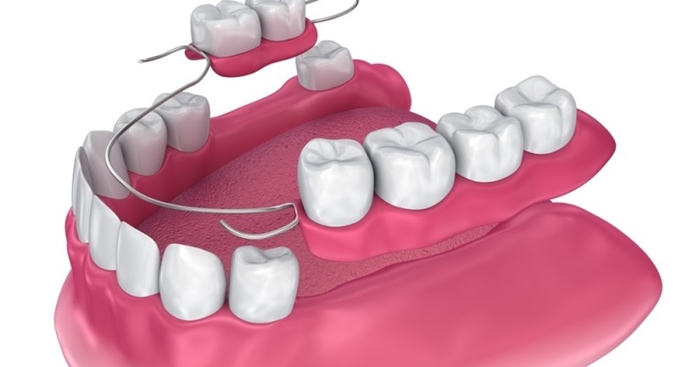 What Are the Different Types of Dentures? - Aussie’s Mag