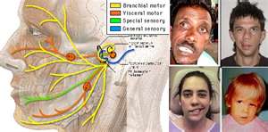 Pathophysiology: BELL'S PALSY