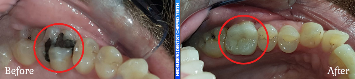 Chipped Tooth Repair Molar