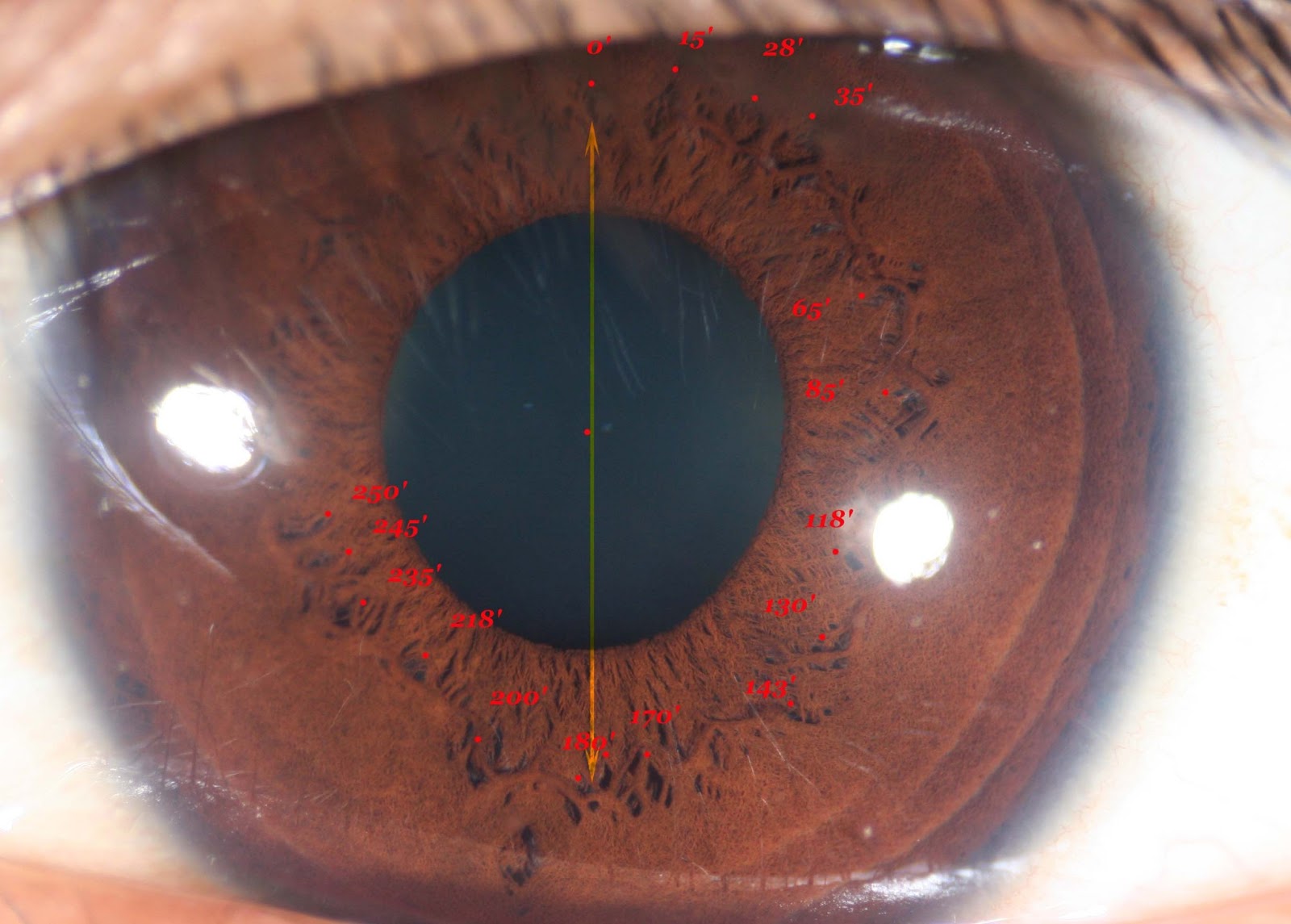 Modern & Multidimensional Iridology: IPB Morphology, Space Risk, Stress ...