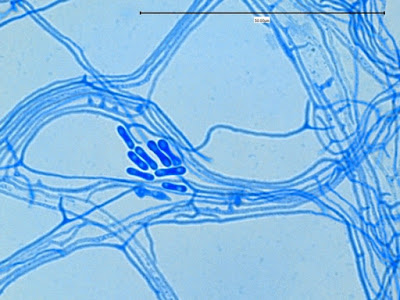 Fun With Microbiology (What's Buggin' You?): Sarocladium kiliense