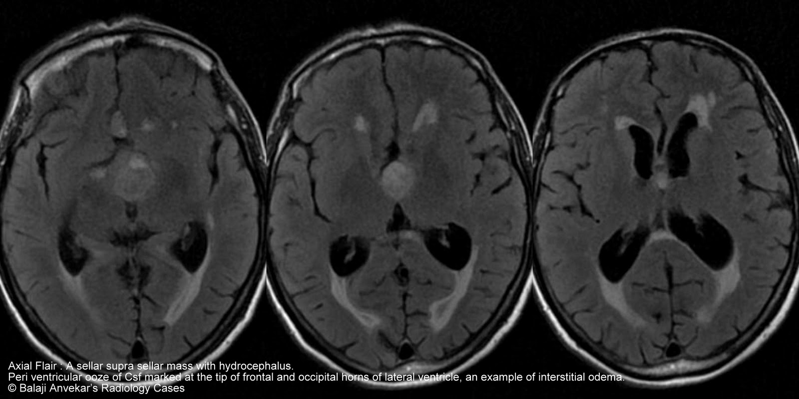 Dr Balaji Anvekar FRCR: Cytotoxic vs Vasogenic odema