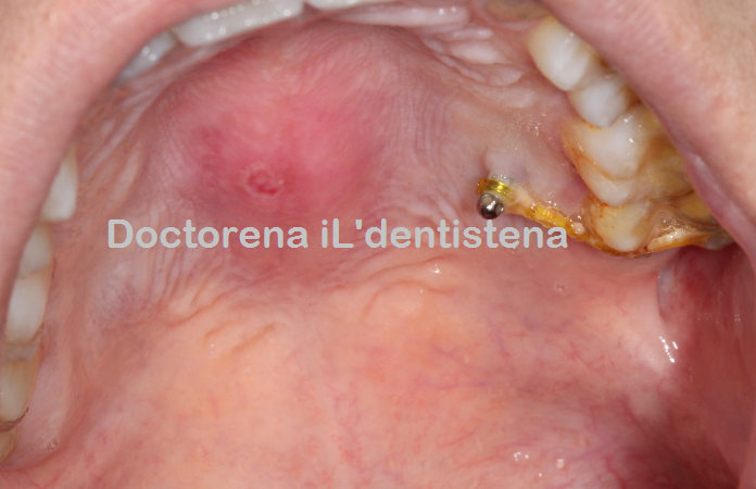 My Dental Diary: Torus palatinus - clinical case