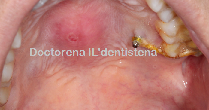 My Dental Diary: Torus palatinus - clinical case