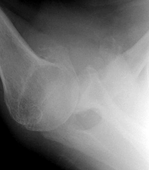 Shoulder Arthritis / Rotator Cuff Tears / Shoulder Pain : Ream and run ...