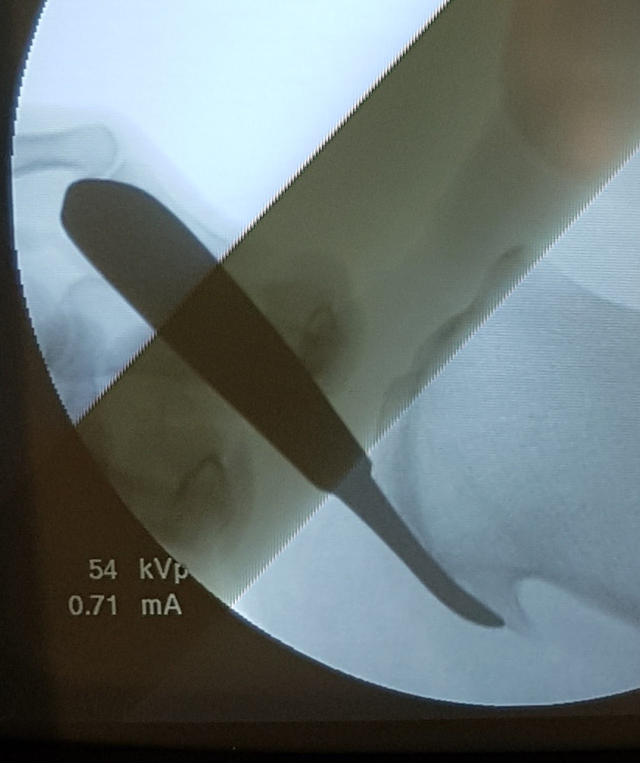 Podo Basas al Día: Fascitis plantar con Topaz. Espolón calcáneo. Rotura ...